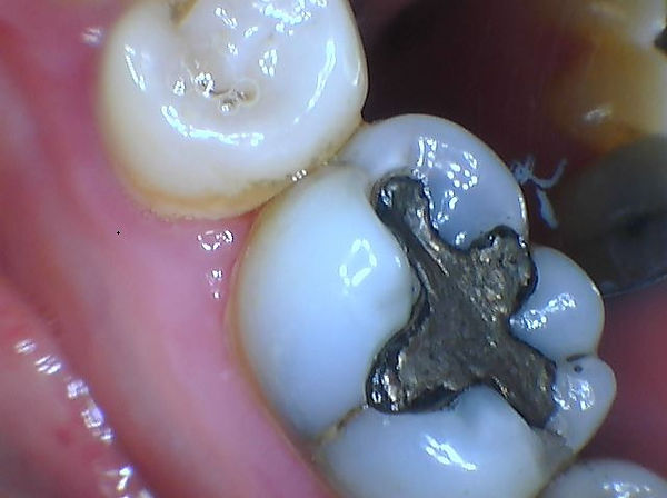 Amalgam Fillings | Amalgam Filling Removal | Amalgam Filling